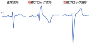 健診で「右脚ブロック」を指摘されました… ｜ 一般社団法人 日本循環器協会｜Japanese Circulation Association